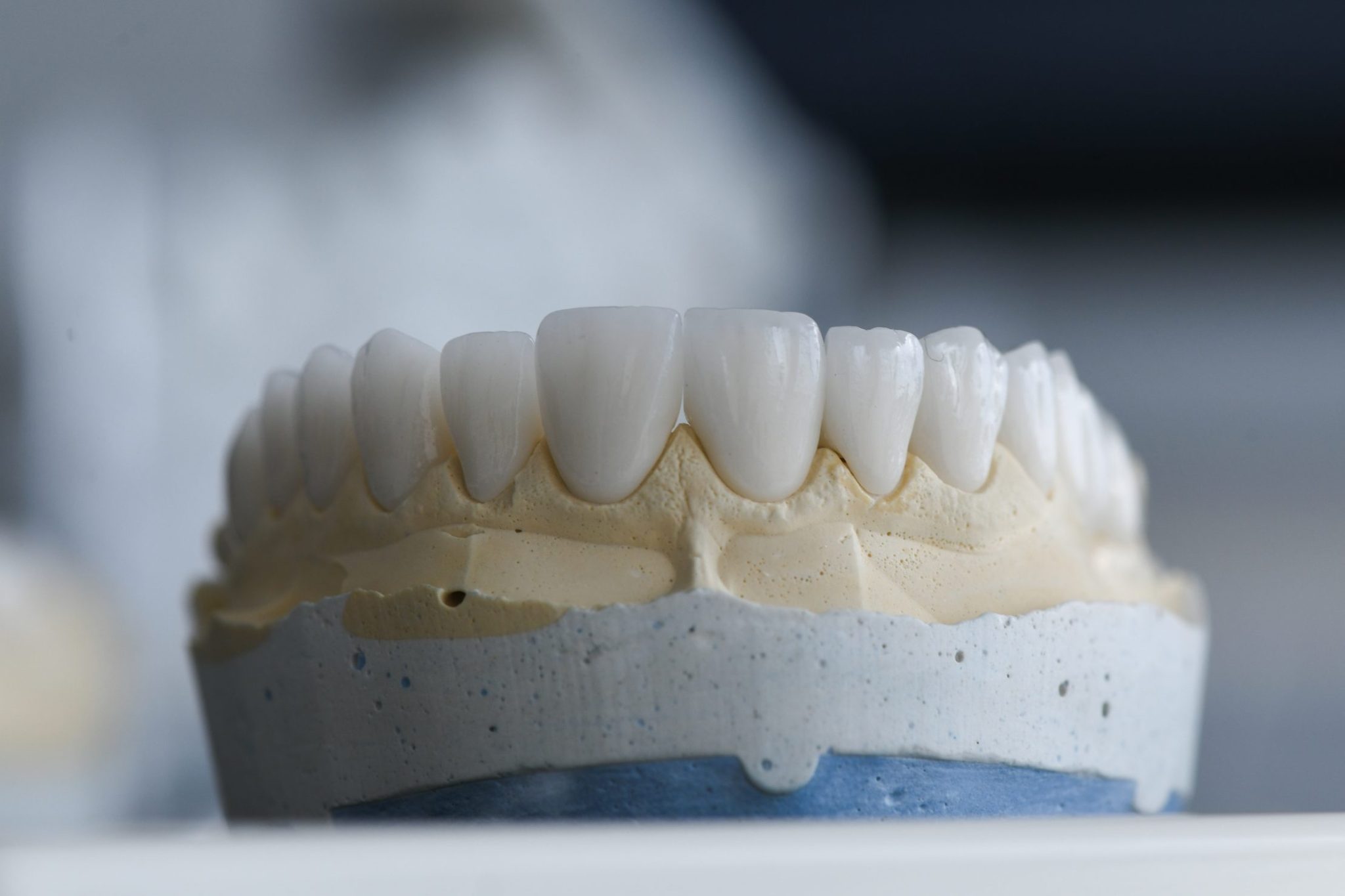 CEREC Same-Day Crowns in Colorado Springs - Pine Creek Dental